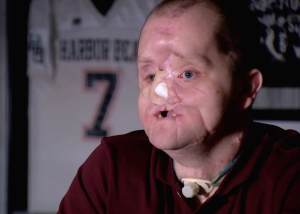 Rochester's Mayo Clinic successfully completes face transplant for ...