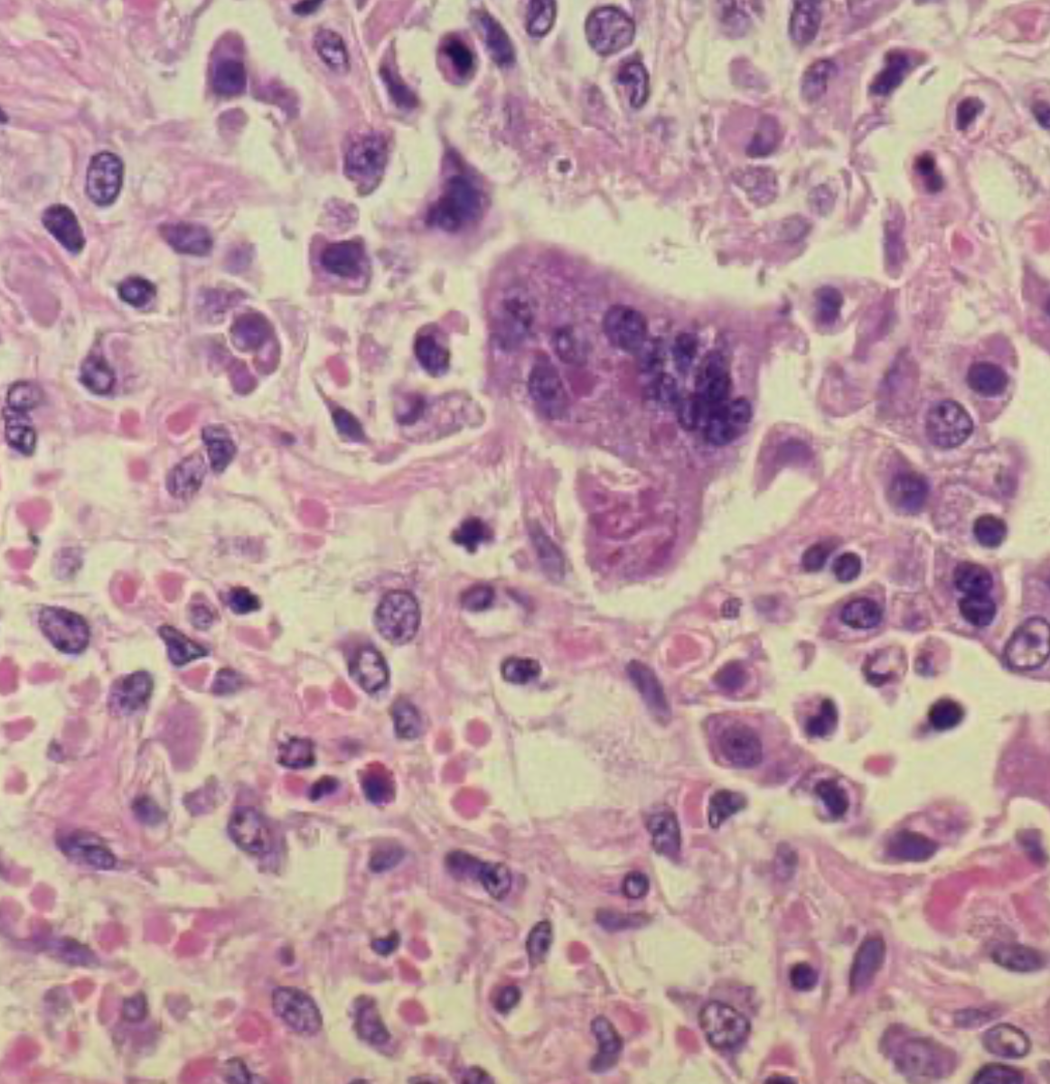 Measles confirmed in four Minnesota counties; 21 cases in past five ...