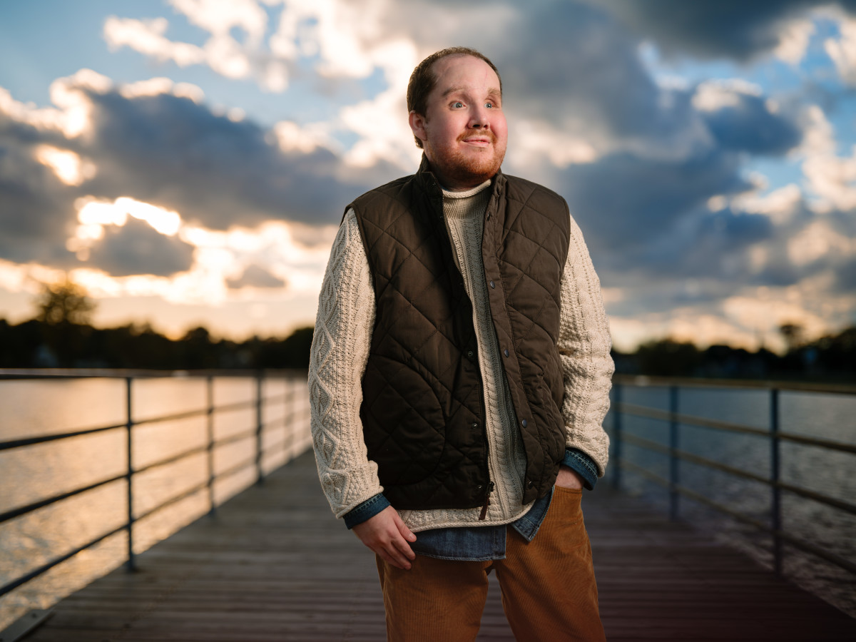 Rochester's Mayo Clinic successfully completes face transplant for ...